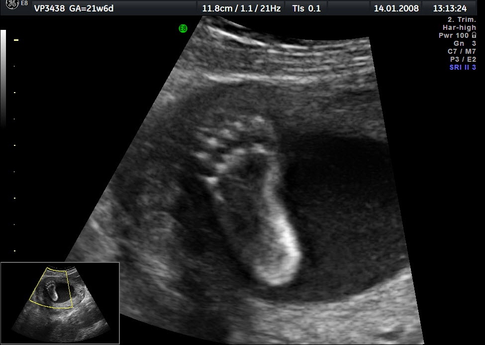 22. SSW-Ultraschall – Praenatal.ch